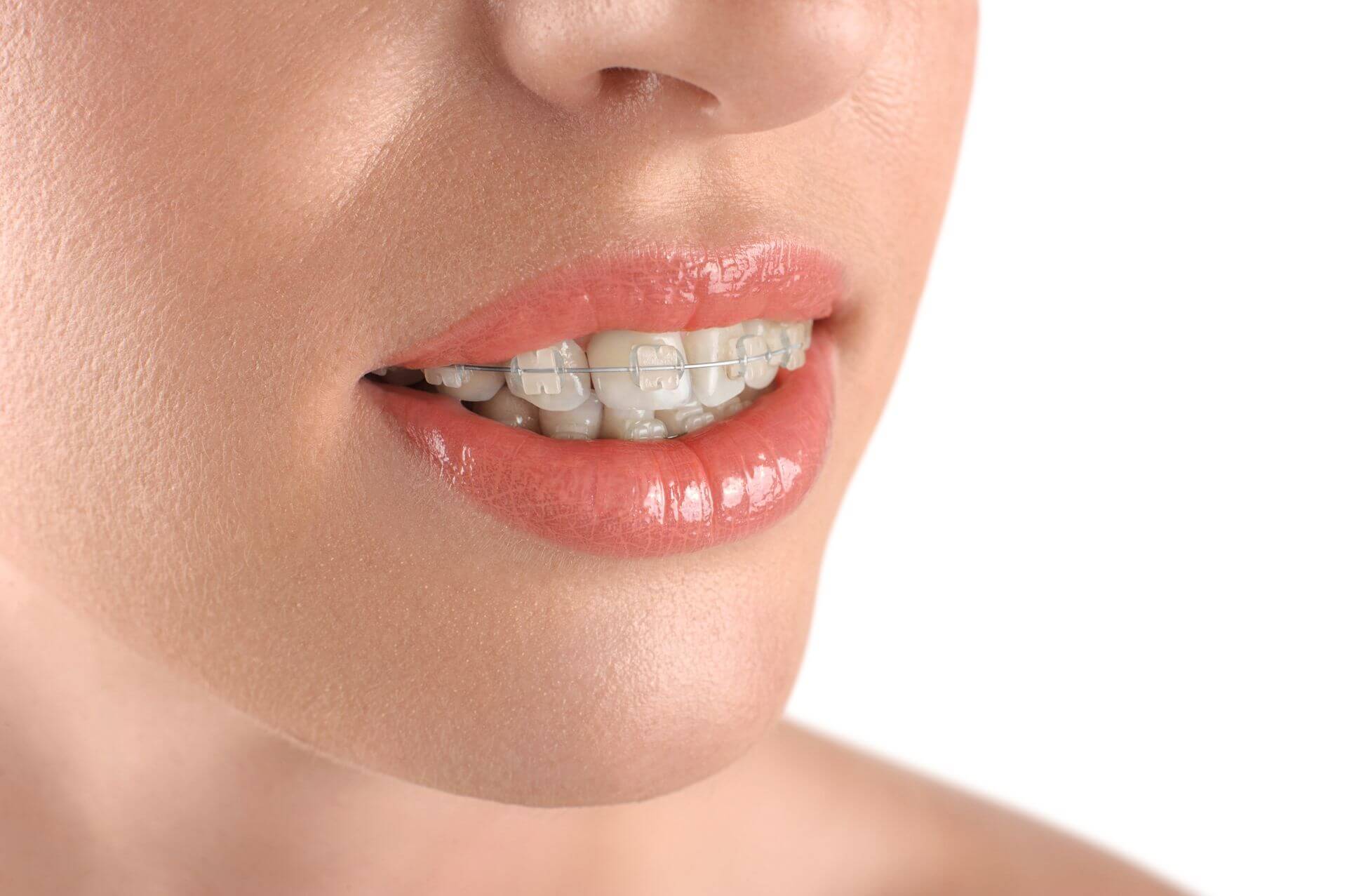 Ortodonzia invisibile: apparecchio dentale fisso interno - STUDIO RENDA Ortodonzia invisibile: apparecchio dentale fisso interno - STUDIO RENDA